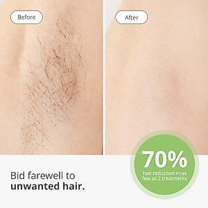 Tria Hair Removal Laser 4X - Safe At-Home Laser Hair Removal for Women and Men - Green