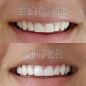 MOON Teeth Whitening Kit with LED Light, Wireless, 5 Minute Treatment, Gentle on Teeth, Helps Remove Stains from Coffee, Smoking, Wine, Soda