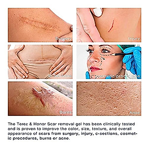 Scar Cream Gel, Advanced Silicone Scar Gel for Surgical Scars, C-Section, Stretch Marks, Acne, Surgery, Surgical Effective Treatment, Old and New Scars Management - 30g