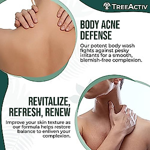 TreeActiv Acne Exfoliating Body Wash, 8oz, Foam Cleanser for All Skin Types, Sulfur, Aloe Vera, Jojoba Beads