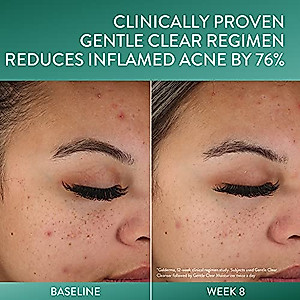 Cetaphil Face Moisturizer, Gentle Clear Mattifying Acne Moisturizer With 0.5% Salicylic Acid, Hydrates and Treats Sensitive Acne Prone Skin, Skin Care for Sensitive Skin, 3oz