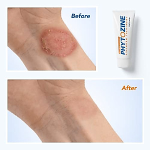 PHYTOZINE Ringworm Cream - Treats Stubborn Ringworm Infections, Fights Ringworm On Skin, Anti-Fungal Tolnaftate, Powerful Topical Treatment (1 Ounce)