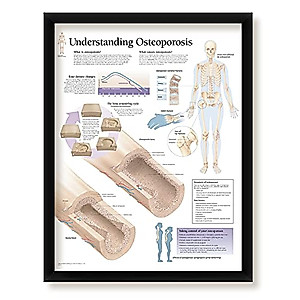 Set of 3 Framed Medical Posters Osteoarthritis Rheumatoid Arthritis Understanding Osteoporosis 22"x28" Wall Diagrams Educational Informational Doctors Office Rheumatology Charts