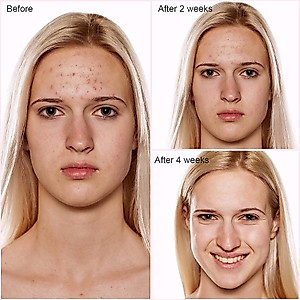 NewWay 3 Colors Wireless led Facial Light T herapy for Face Skin Rejuve Wrinkle Reduction Skin Care Anti-ging