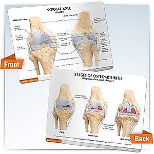 GPI Anatomicals Knee Joint Model Set | Human Body Anatomy Replica Set of 4-Stage Osteoarthritis Knee Joint for Doctors Office Educational Tool