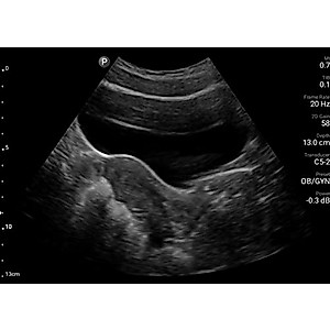Philips Lumify C5-2 Curved Array Transducer, Portable Ultrasound Solution