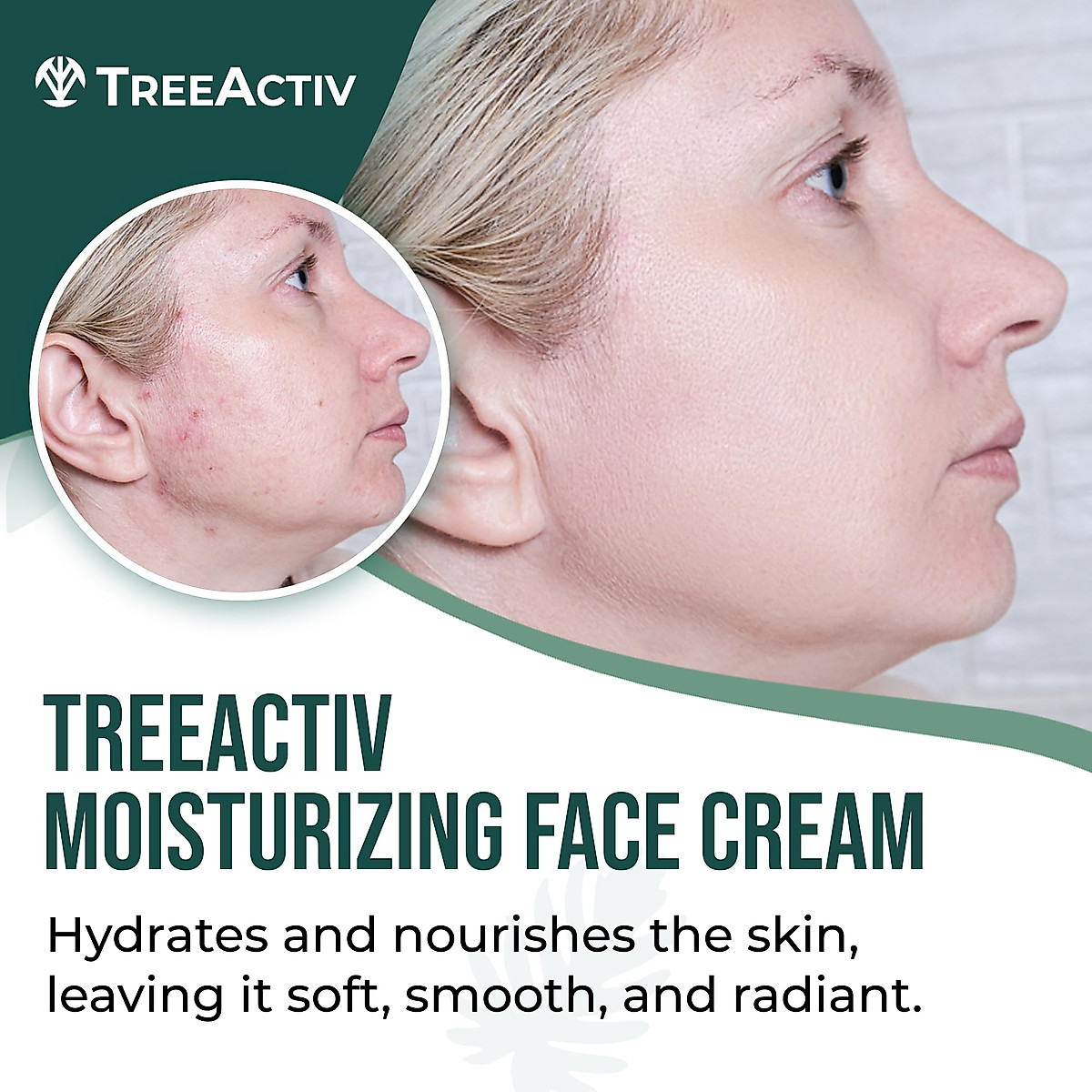 TreeActiv Salicylic Acid Face Moisturizer, 2 fl oz, Acne Treatment Face Cream for Oily Skin with and Tea Tree Oil, For Teens and Adults with Acne Prone Skin and Cystic Acne, 90 Day Supply