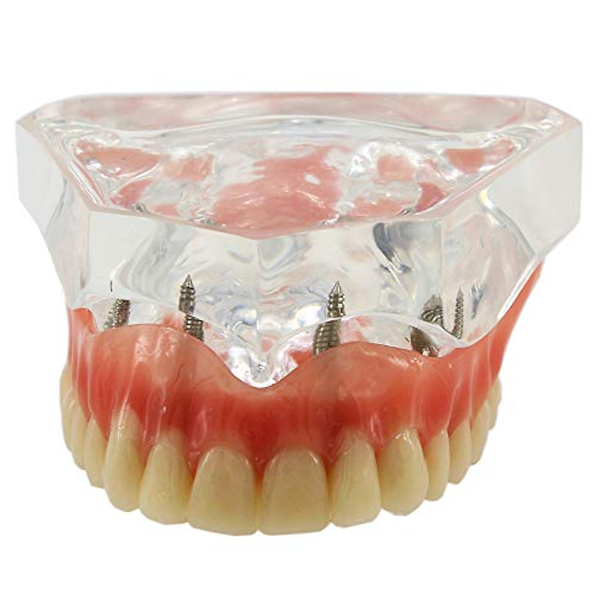DENTALMALL Dental Upper Implants Model Overdenture with 4 Superior Teeth Demo Transparent Vision for Education and Study Model Tool M6001 C