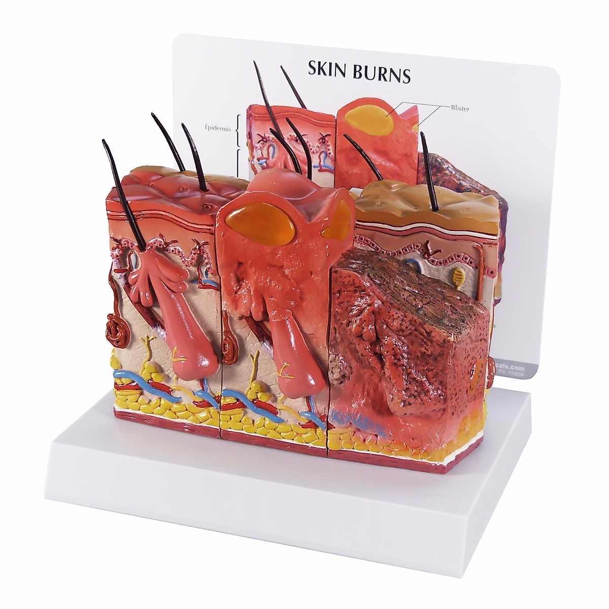 Skin Burn Model | Human Body Anatomy Replica of Varying Degrees of Skin Burn for Dermatology Educational Tool | GPI Anatomicals