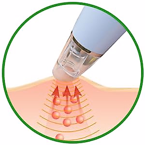 Bug Bite Remover Get Itch Relief from Mosquito Bites with This Suction Tool. This is Similar to The Bug bite Thing seen on Shark Tank, Except Ours is Better with a Battery Powered Suction Pump.