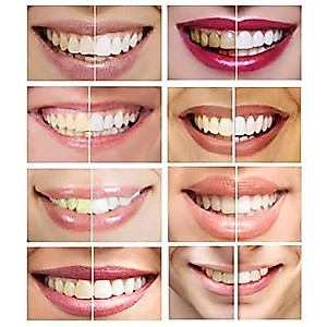 Remineralization Gel Reduces Teeth Sensitivity and Remineralizing After Teeth Whitening Treatment (3, 3ml)