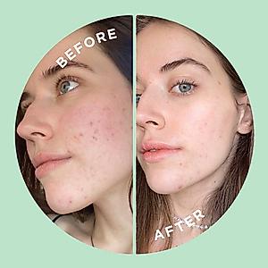 ZitSticka Sheet Masks for Face Skincare- Exfoliating & Hydrating Sheet Mask for Dry & Sensitive Skin - Soothe Breakouts & Acne-Prone Skin - Beauty Facial Skin Care for Woman (Press Fresh 5 Sheets)