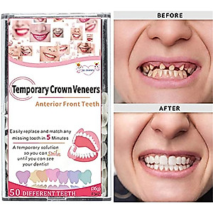 Cleaning Solution Temporary Tooth Kit For Filling The Missing Broken Tooth And Gaps Moldable Temporary Crown Veneers Material Anterior Front Back Molar Teeth Temporary Tooth Filler