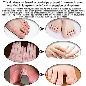 Heat Rash Itch Relief, Extra Strength Cream, Jock Itch, Athlete's Foot Hand Skin, Tinea Versicolor, Armpit, Itchy Feet, Psoriasis, Scalp Dandruff, Fast Relief for Eczema, Rosacea, 24h Soothing Treat