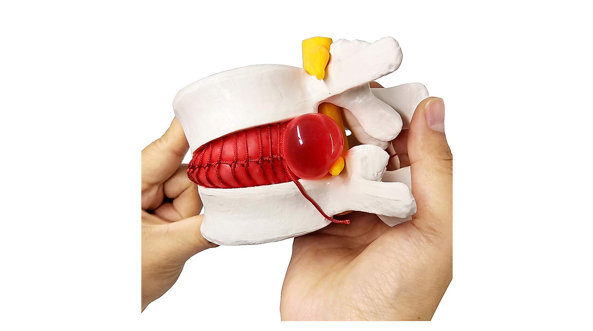 Human Herniated Disc Model for Medical Teaching and Learning