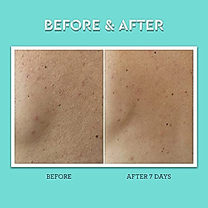 Bliss Clear Genius Body Acne Spray - 3.5 Fl Oz - Maximum Strength 2% Salicylic Acid & Niacinamide - Targets Body Acne & Prevents Future Breakouts - Post Workout - Clean - Vegan & Cruelty-Free