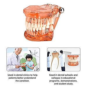 Maxmartt Teeth Model, Dental Demonstration Dental Implant Removable Study Model Teeth Teaching Model for Student Teacher, Orange