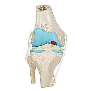 Spancare 4 Stage Osteoarthritis Anatomical Knee Model, Model On Base, with Detailed Study