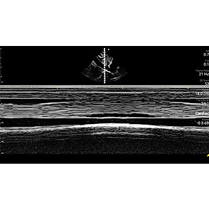 Philips Lumify S4-1 Phased Array Transducer, Portable Ultrasound Solution