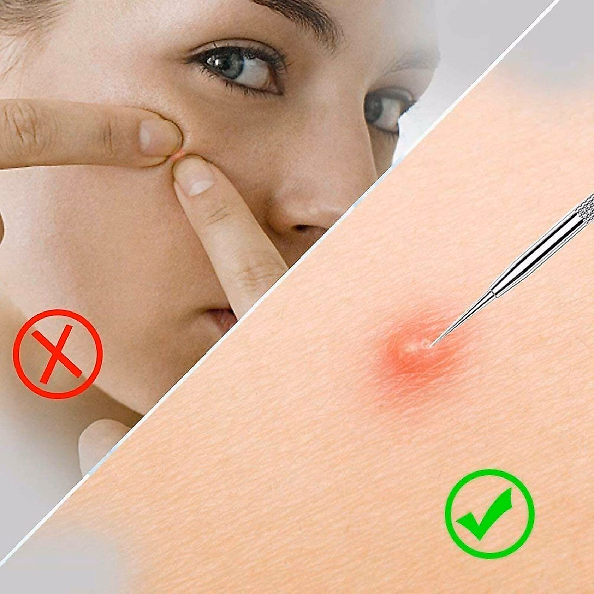 Blackhead Remover Pimple Comedone Extractor Tool Acne Kit - Treatment for Blemish, Whitehead Popping, Zit Removing for Risk Free Nose Face Skin (Sliver)