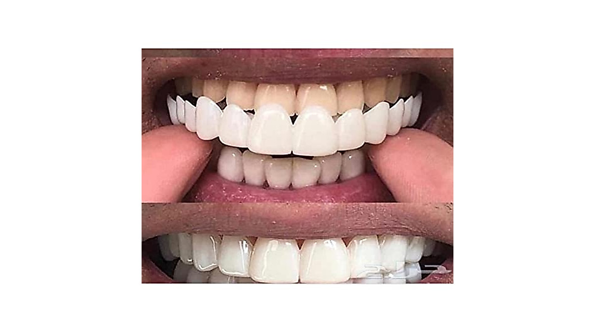 Snap Smile Upper False Teeth - Perfect Fit for a New You