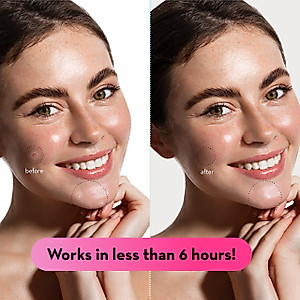 LE GUSHE Pimple Patches for Face (132 dots) - Hydrocolloid Acne Patch for Zits and Blemishes - Invisible Blemish Patches for Face - Spot Cover Stickers