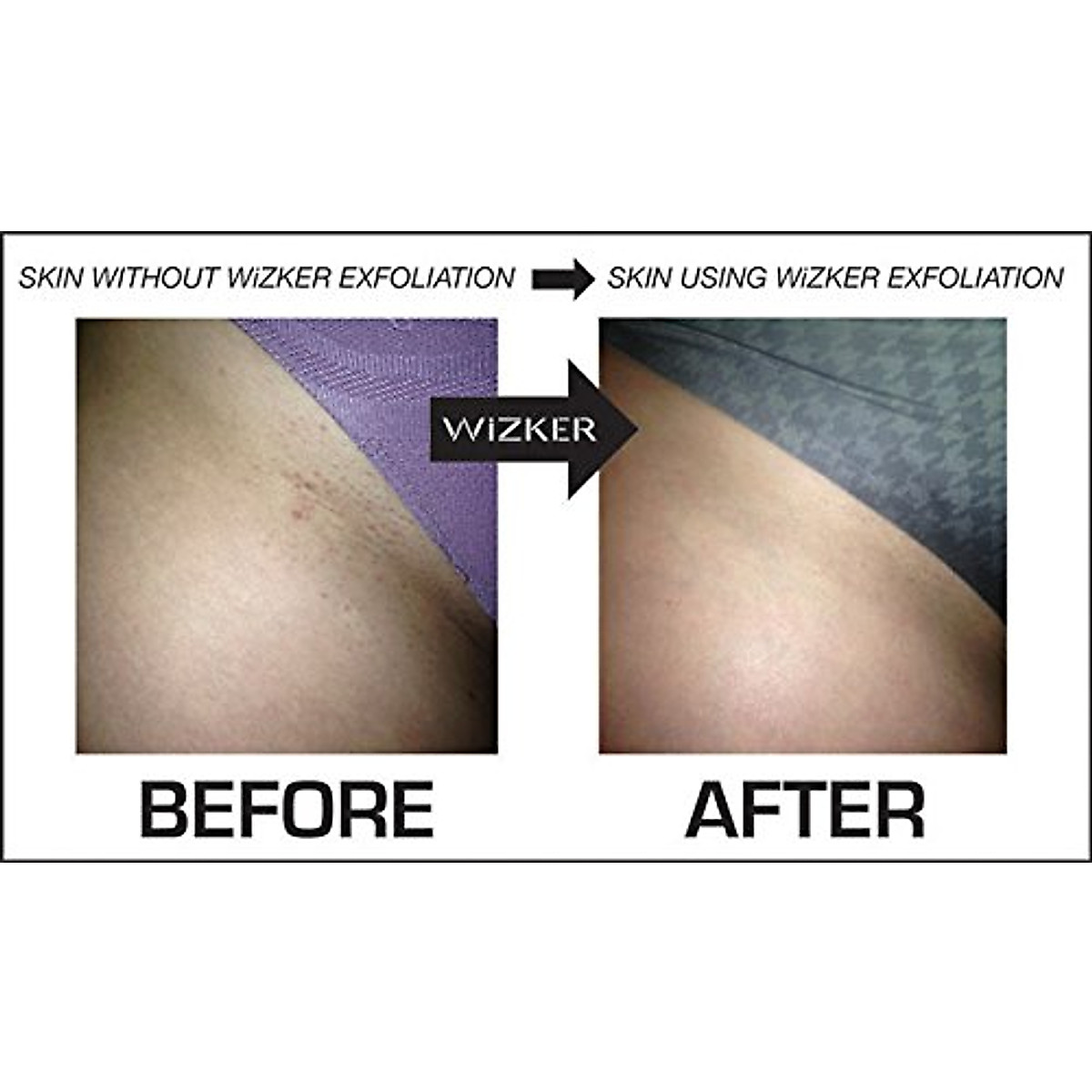 WIZKER Exfoliating Brush: Ingrown Hair Prevention, Razor Bump Treatment | Original Extra-Strength Bristle Exfoliator for Face, Body, Leg, Bikini | Shaving and Waxing Solution | Bath Shower Waterproof