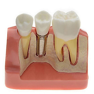 Analysis Model for Dental Implant Crown Bridge Demonstration Teeth Model for Education M2017