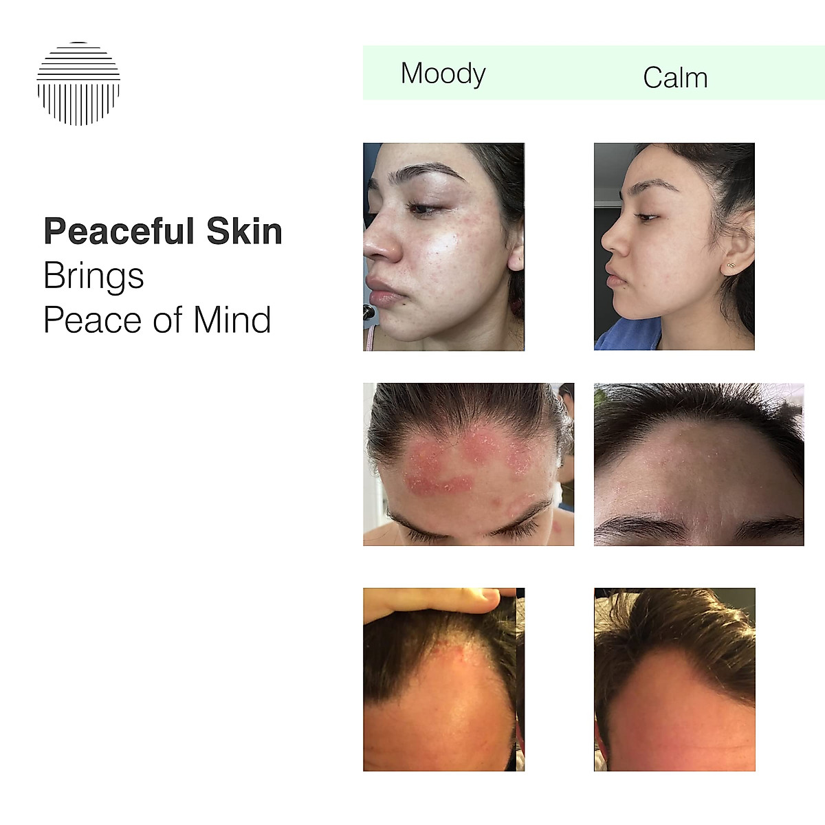 Dermazen Calming Seborrheic Serum, Dermatologist Recommended, Topical Serum For Hair, Face, and Body (4oz)