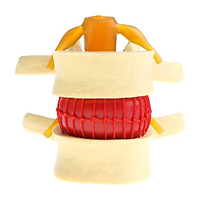 BONEW 4PCS Magnify 2X Human Spine Lumbar Vertebrae Degenerative Disc Medical Model