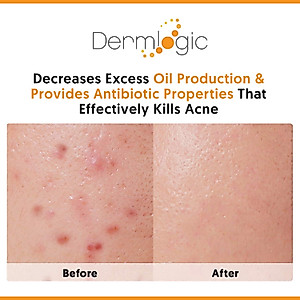 Dermlogic Acne Face & Body Cream- Maximum Strength Treatment for Cystic, Blackhead & Whitehead Pimples. Prevents Future Breakouts.