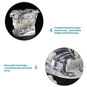 Dentalmall Dental Oral Typodont Model Implant Pathological Removable Teach Demo Visible Anatomy Demonstration Teaching Standard Size (Clear)