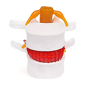 Anatomical Herniated Lumbar Vertebrae Disc Prolapse Model Human Medical Anatomy