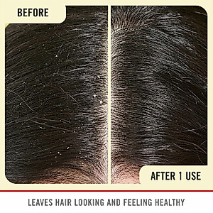 First Aid Beauty FAB Anti-Dandruff Shampoo – Fights Flakes, Soothes Scalp And Leaves Hair Looking Healthy – 8 oz