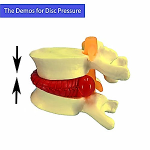 Veipho Human Anatomical Lumbar Disc Herniation Model, 1.5 Times Life Size Lumbar Disc Herniation Model, Human Lumbar Disc Herniation Model for Teaching, Learning, Demonstrating