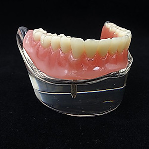 Smile1000 Dental Model Overdenture Inferior 2 Implants Demo for Studing and Teaching