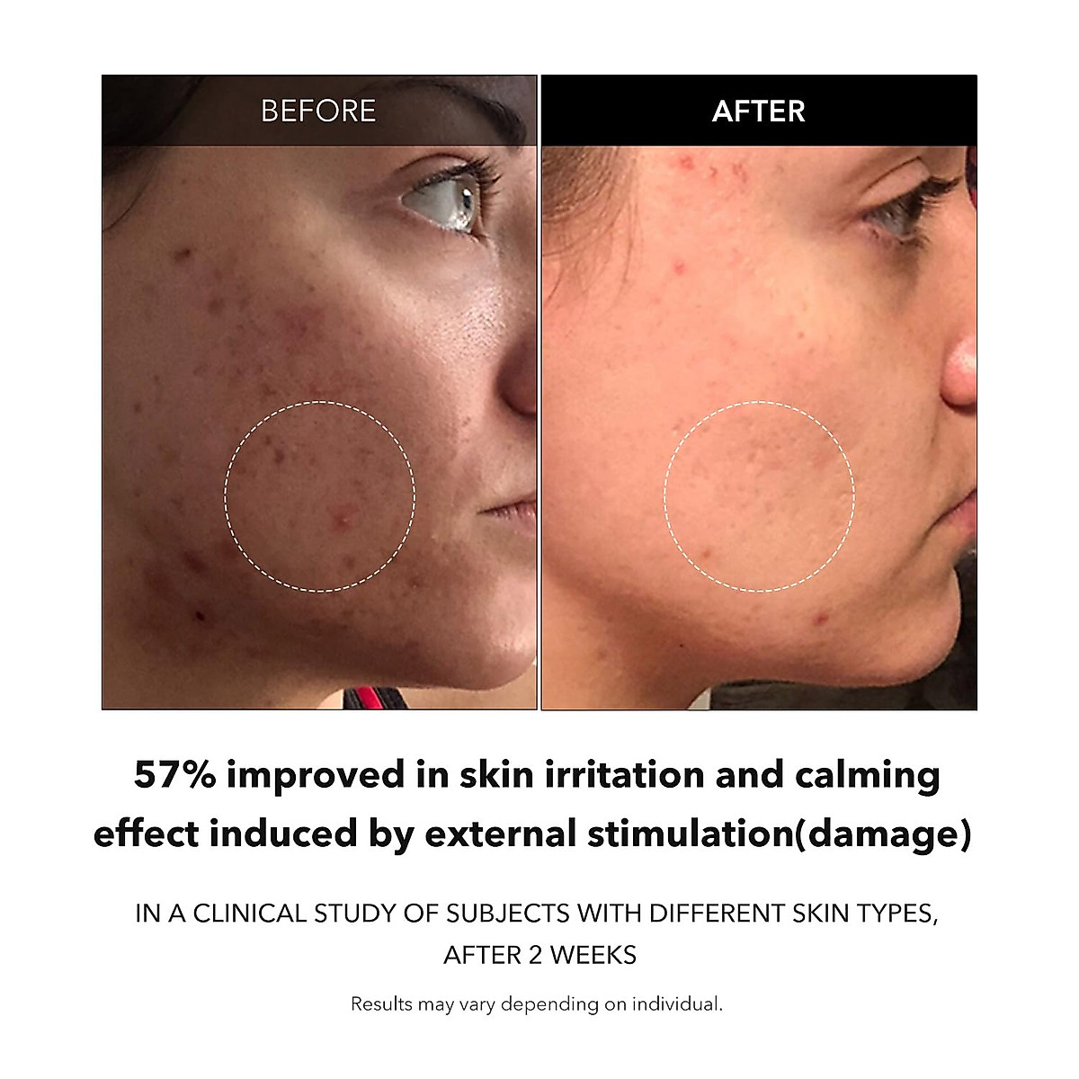 APRILSKIN Carrotene Clarifying Facial Serum | Vegan, Non-comedogenic | Blemish Clear, Dark Spot Corrector | Korea Skincare | Oily Skin, Sensitive Skin, Bumpy Skin | 1.25 fl.oz