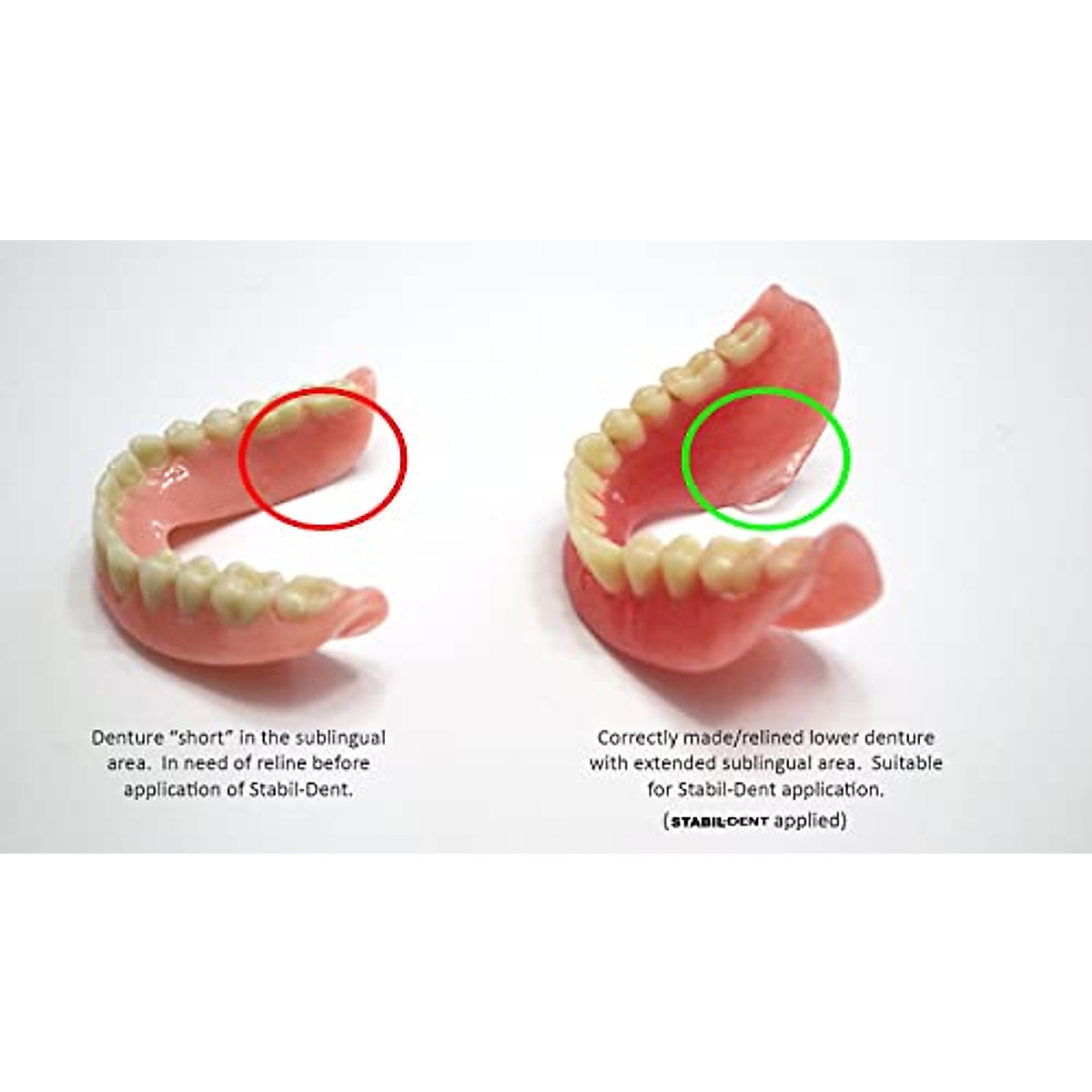 Lower Denture Stabilizers