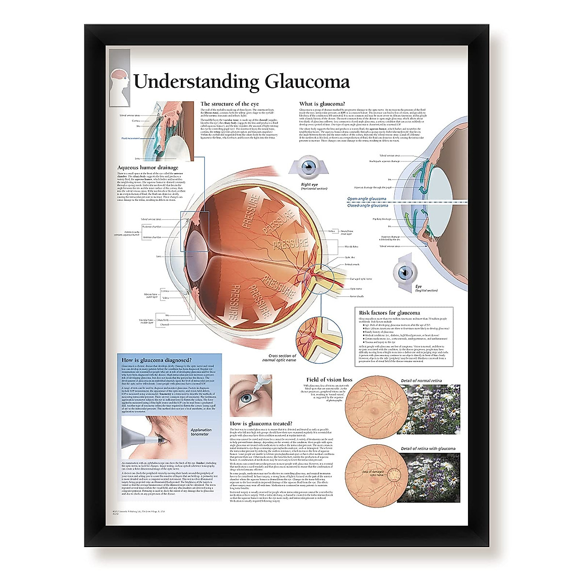 Set of 2 Framed Medical Posters The Eye and Understanding Glaucoma 22"x28" Wall Diagrams
