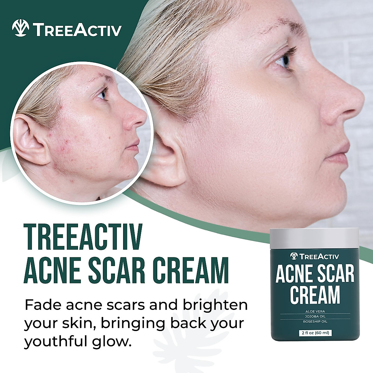 TreeActiv Acne Scar Cream, 2 fl oz, Acne Scar Treatment for Face, Stretch Marks, and Body Scars, Acne Scar Removal Cream for Body, Acne Scar Remover for Cuts and Burns, For All Skin Types, 500+ Uses