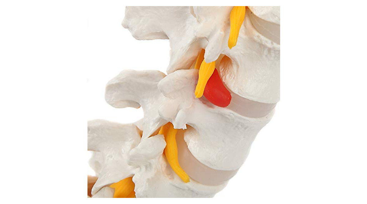 Lumbar Spine Anatomy Model with Nerves & Herniated Disc | Axis Scientific