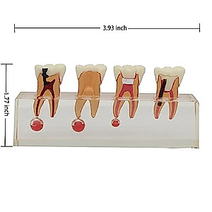 Dentalmall Dental 4-Stage Endodontic Treatment Model for Study Teach Teeth Model 4018 Root Canal Anatomy Demonstration Teaching Tooth Model