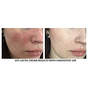 Planet Eden 20% Gly-Lactic Face and Body Skin Cream Lotion - 10% Glycolic and 10% lactic Acid for Exfoliation (8 oz)