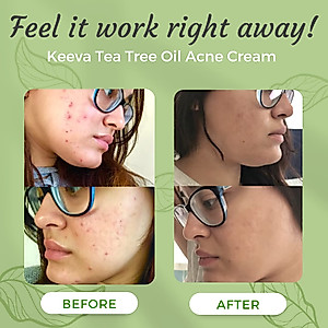 Keeva Organics Acne Treatment Cream With Secret TEA TREE OIL Formula - Perfect For Acne Scar Removal, Fighting Breakouts, Spots, Cystic Acne - See Results in Days Without Dry Skin (1oz)