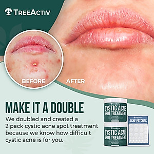 TreeActiv Cystic Acne Spot Treatment, 2-Pack, Sulfur Spot Treatment, Hormonal Acne Treatment with Tea Tree, Cystic Acne, Blackheads, Cystic Acne Treatment and Pimple Spot Treatment for Face, 240+ Uses