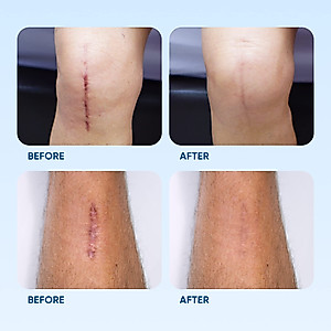 Silicone Scar Removal Sheets - Breathable Reusable & Waterproof Keloid Scar Removal Patches Caused by C-Section, Surgery, Burn, Acne, Stretch Marks Healing Alternative to Gel, Tape & Cream (4 sheets)