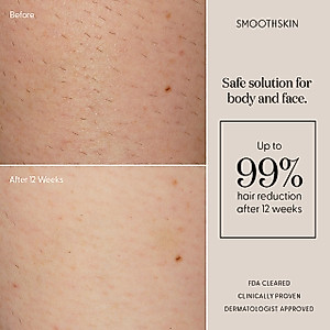 Smoothskin Pure IPL Laser Hair Removal Device for Women & Men, Long-Lasting, for Body, Bikini & Face, Alternative to Laser & Bikini Shaver