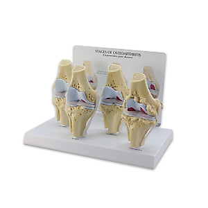 GPI Anatomicals Knee Joint Model Set | Human Body Anatomy Replica Set of 4-Stage Osteoarthritis Knee Joint for Doctors Office Educational Tool