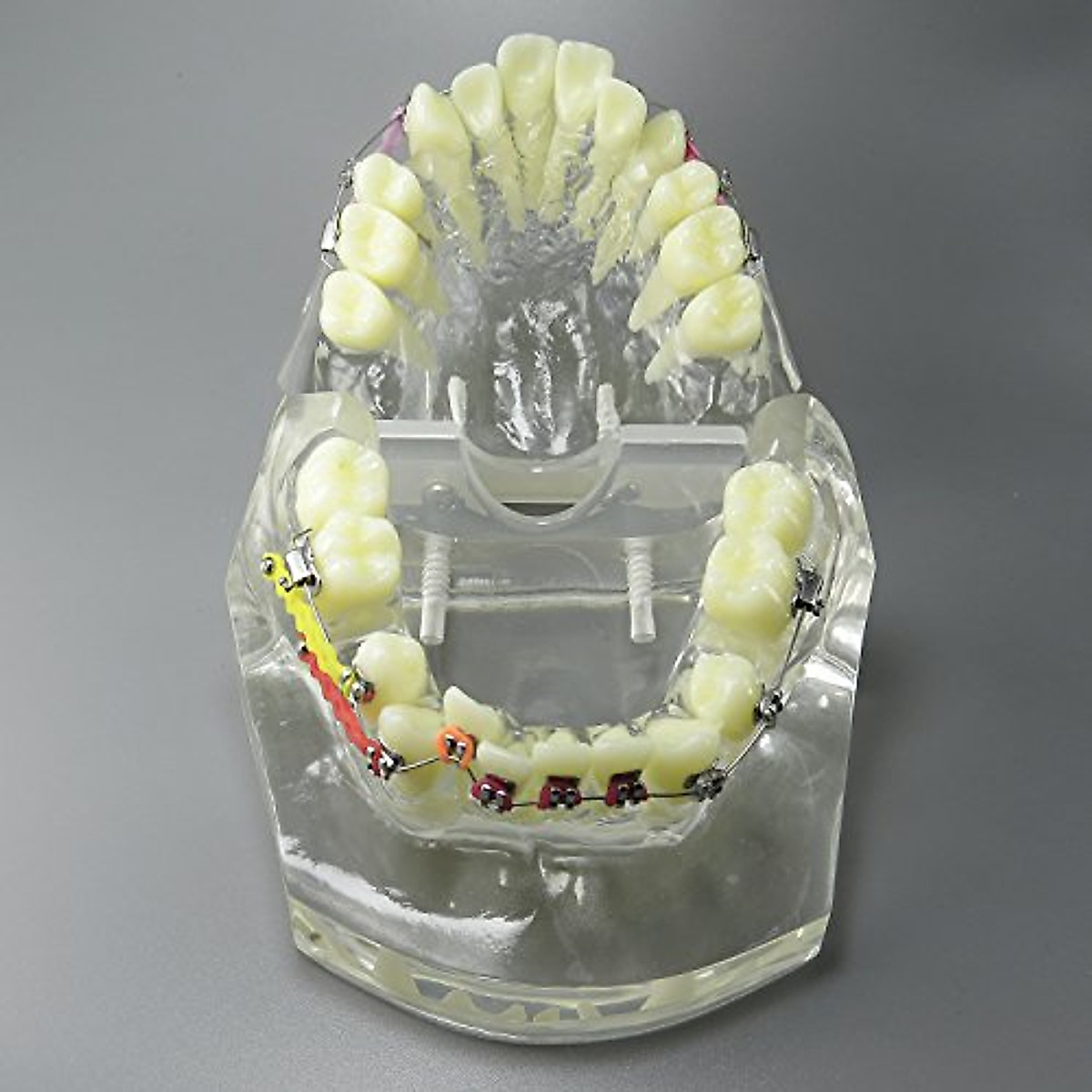 Smile1000 Dental Malocclusion Orthodontic Treatment Teeth Model with Metal Brackets Wires Colorful Ties Chains and Hoops M3005