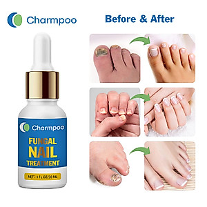 Charmpoo Fungus Nail Treatment for Toenail: Toenail Fungus Treatment Extra Strength - Toe Nail Antifungal Treatment Maximum Strength - Effective Fungal Nail Treatment for Fingernail&Toenail